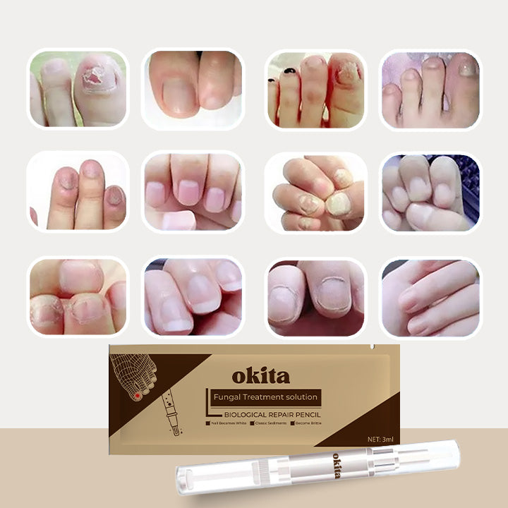 Fungus Relief Treatment Pen™ – Okita US
